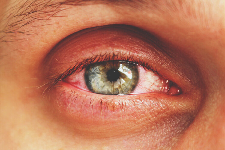 Eye Infection Boynton Beach | Infections Florida | Joshi Eye Institute