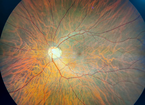 What is Central Serous Chorioretinopathy? | Joshi Eye Institute