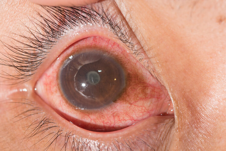 Uveitis Boynton Beach | Eye Doctor Boynton Beach | Joshi Eye Institute